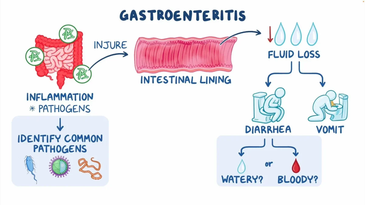 Gastroenteritis Understanding The Stomach Bug Gastroenteritis Understanding The Stomach Bug
